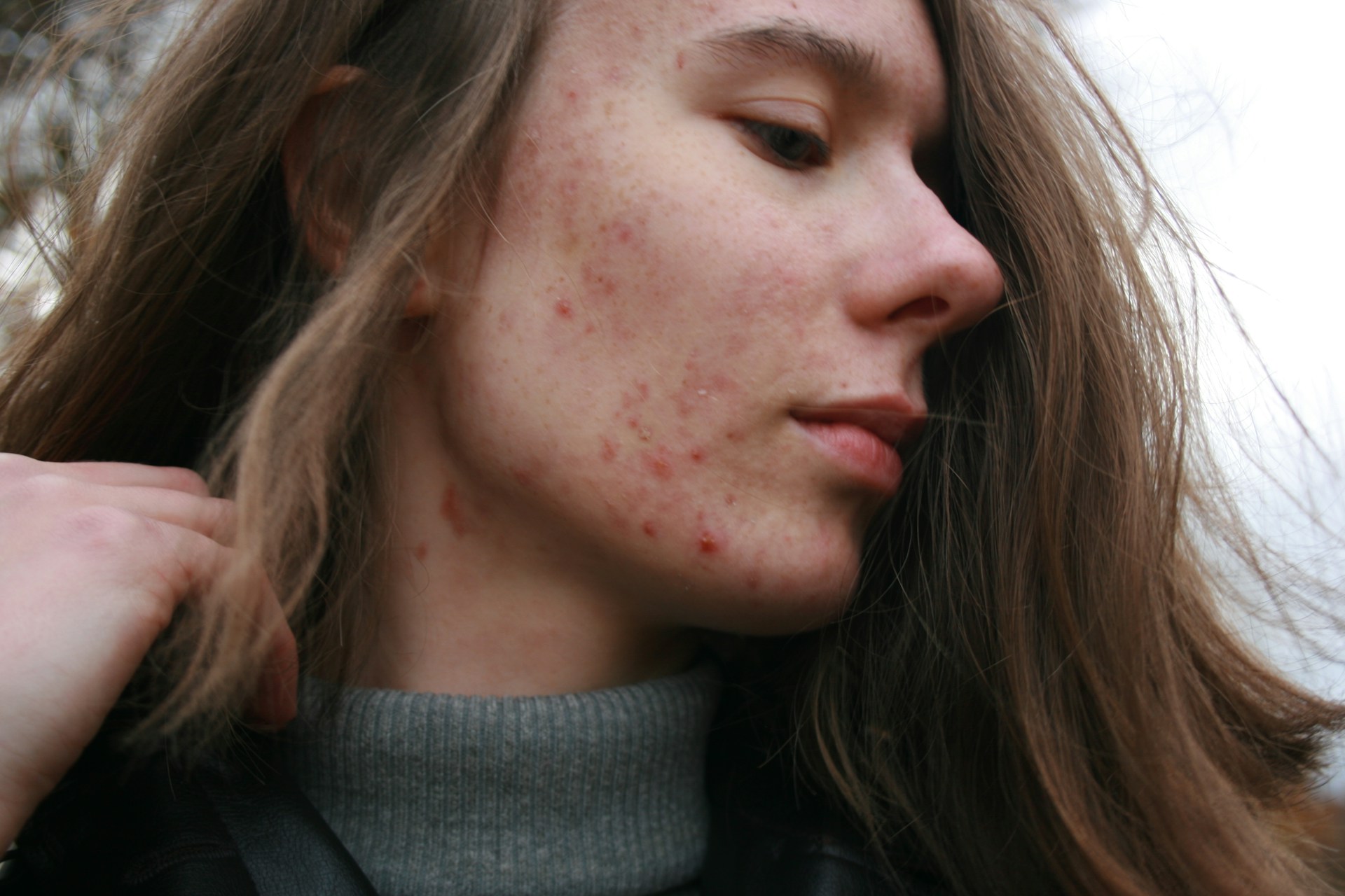 Signs It Might Be Time for Acne Scar Treatment